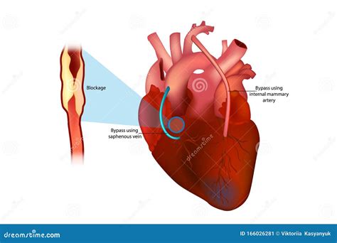 Coronary Artery Bypass Surgery Is A Surgical Procedure To Restore