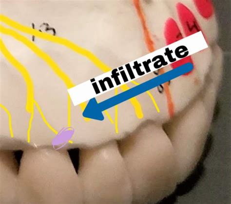 Infiltration Vs Nerve Block