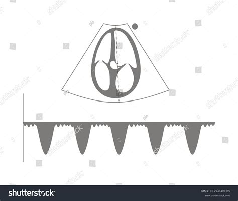 Infographic Echocardiography Left Ventricular Outflow Tract Stock