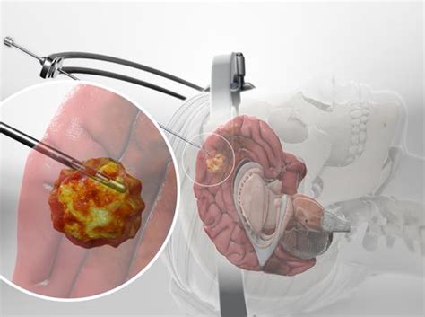 Video Stereotactic Brain Biopsy Needle Biopsy Method Healthclips