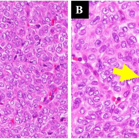 Preoperative Computed Tomography Findings A E Five Download Scientific Diagram