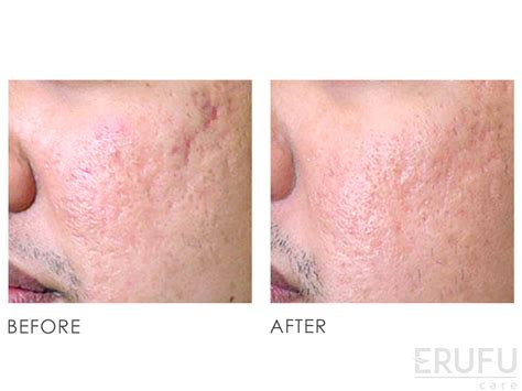 Top 5 Pdrn Injection Treatment In Kuala Lumpur Price Guide And Reviews