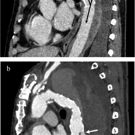 Illustration Of The Knickerbocker Technique In A A Type B Aortic