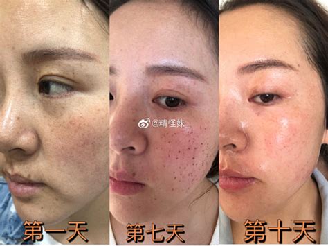 祛斑 投稿我就是典型的雀斑脸困扰我20多年之后我终于把它搞掉了哈哈第十天我感觉斑点就淡了好多好多感觉再来几个疗程就能回归没有长斑的时候啦