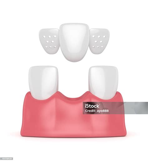 메릴랜드 브릿지 치과 치아의 3d 렌더링 3차원 형태에 대한 스톡 사진 및 기타 이미지 3차원 형태 개과 건강관리와 의술