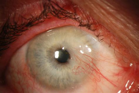 Pinguecula Eye Causes Symptoms Diagnosis And Pinguecula Eye Treatment