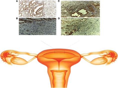 Frontiers The Role Of The Junctional Zone In The Management Of Adenomyosis With Infertility