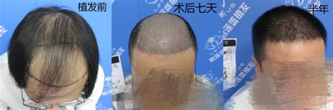 5000个毛囊植发的价格大约是多少？