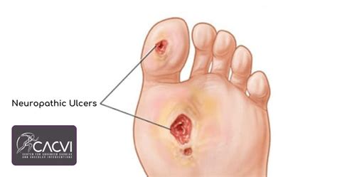 Leg Ulcer Pictures 2025 Cacvi