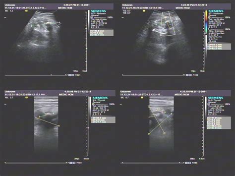 Viêm Túi Thừa đại Tràng Sigma Sigmoid Diverticulitis