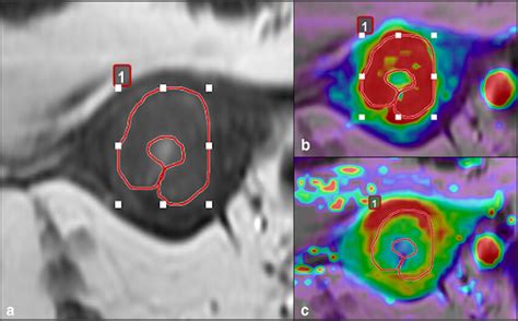 Dce Mr Perfusion Analysis A T2 Wi Showing A 2d Roi Drawn On A Large