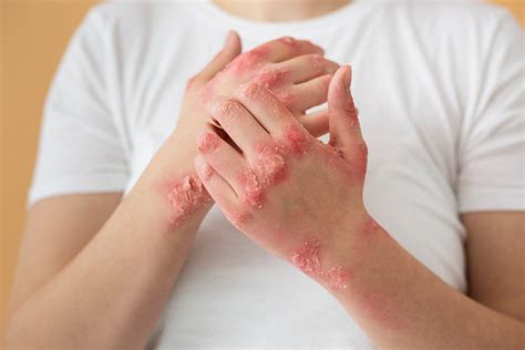 Skin Inflammation Explore Causes And Effective Treatments
