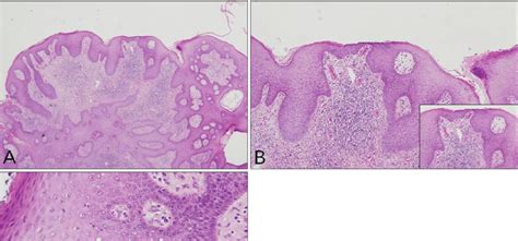 A Acanthosis Composed Of Clear Cells Regular Elongation Of Rete