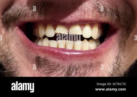 Damaged And Broken Front Teeth Inside Human Mouth Dental Health