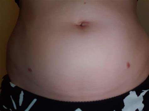 6 Months Post Laparoscopy And My Scars Are Still Pretty Noticeable Endo