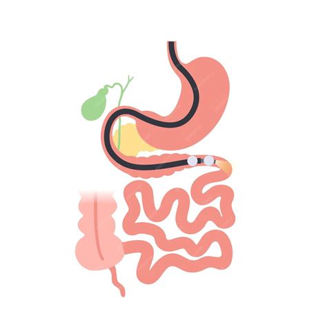 Premium Vector Balloon Assisted Enteroscopy Visualization Of The