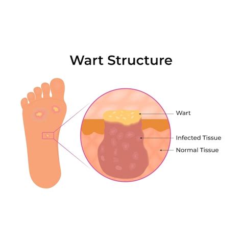 Wart Structure Detailed Diagram Of Foot Wart And Tissue Layers Vetor