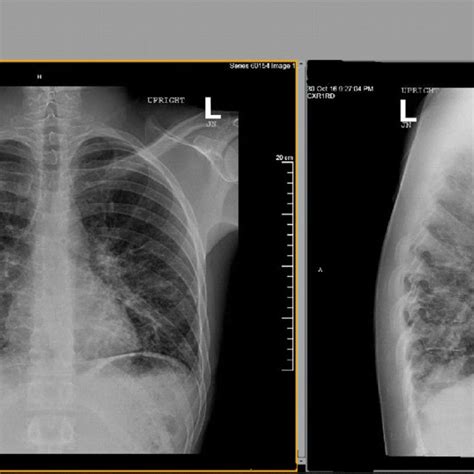 High Resolution CT Scan Showing Diffuse Irregular Opacities With Download Scientific Diagram