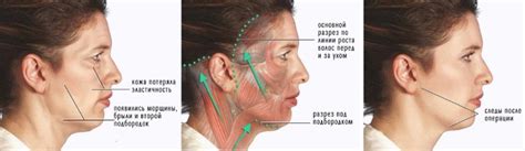 Подтяжка лица Лифтинг подтяжка овала шеи крем для кожи нити маски