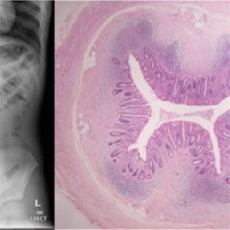 Pdf Primary Peritonitis A Forgotten Entity