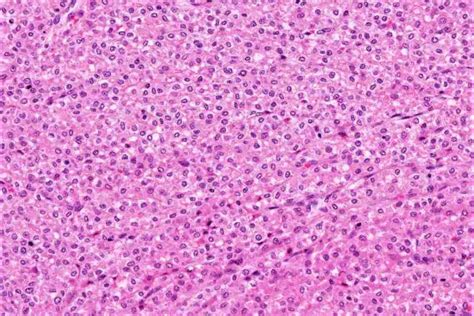 Папілярна карцинома — Kraina One