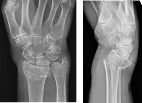 A Patients Guide To Distal Radius Fractures — Dr Nick Golinvaux