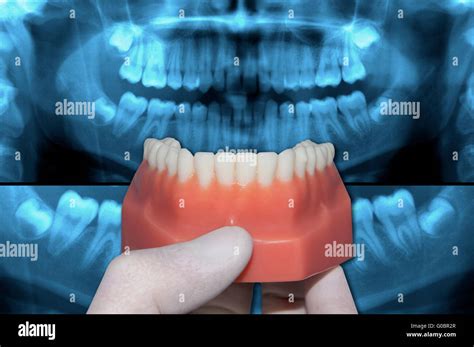 Zygomatic Process Of Maxilla X Ray