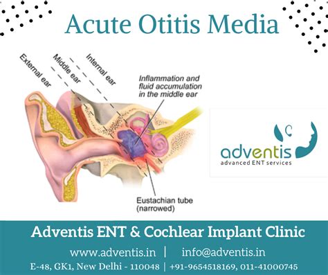 Otitis Interna
