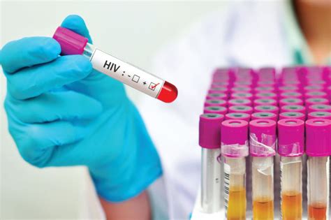 Kaj Je Aids Doktor 24