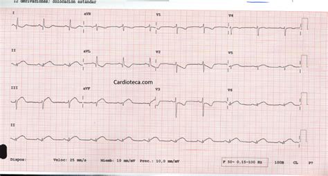 Curso Ecg Infarto Inferior Por Disección De Coronaria Obtusa Marginal