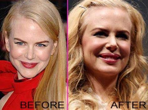 44 bästa bilderna om Botox mistakes på Pinterest Gwyneth paltrow Nicole kidman och Kylie minogue