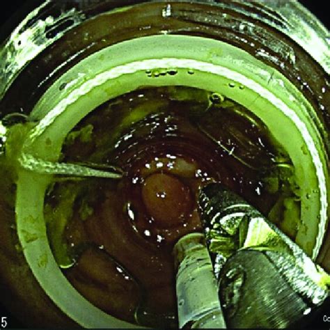 Device Assisted Eftr Procedure Ftrd Ovesco ® Germany Download Scientific Diagram