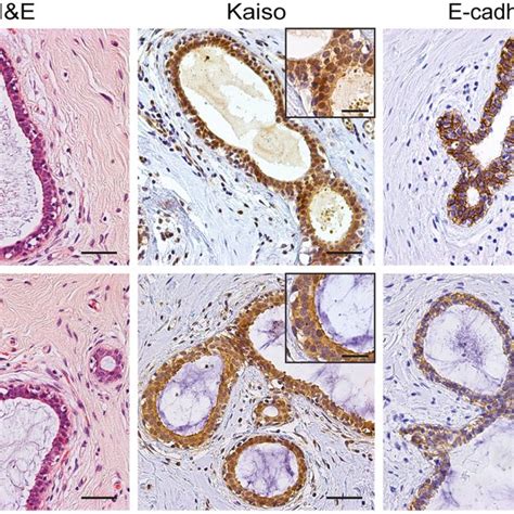 E Cadherin And P120 Membrane Localization Correlates With Nuclear Kaiso