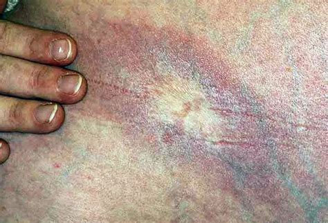 Picture Of Morphea Late Stage On Medicinenet