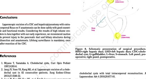 An End To Side Hepaticojejunostomy Was Performed Laparoscopically At