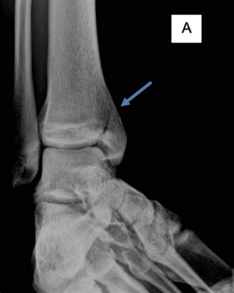 Medial Malleolus Stress Fracture Sports Med Review