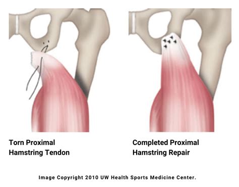 Hamstring Origin Tendinopathy At Troy Carlos Blog