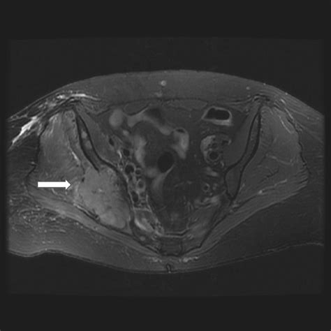 Magnetic Resonance Imaging Of The Pelvis In Axial View Large