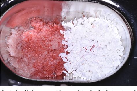 Figure 1 From Barbell Technique For Three Dimensional Bone Augmentation Semantic Scholar