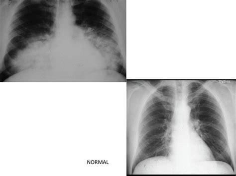 Restrictive Lung Dz Flashcards Quizlet