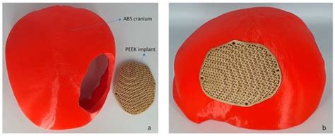 Polyether Ether Ketone Peek And Its 3d Printed Quantitate Assessment In Cranial Reconstruction