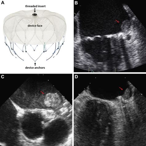 Assessment Of Device Related Thrombus And Associated Clinical Outcomes