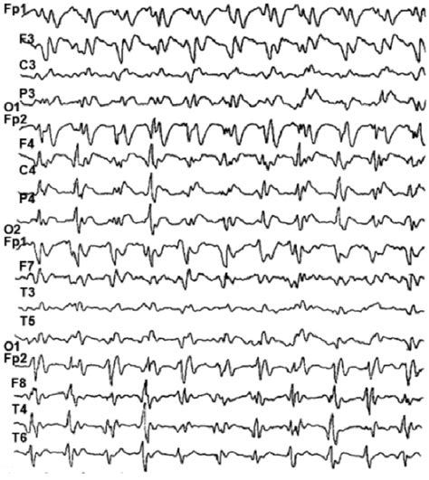 Periodic Sharp Waves At About 1 5 Sec Diffuse Bilateral Slightly