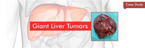 Cancer Tumor Liver The Latest Advances In Liver Cancer Treatment Dr