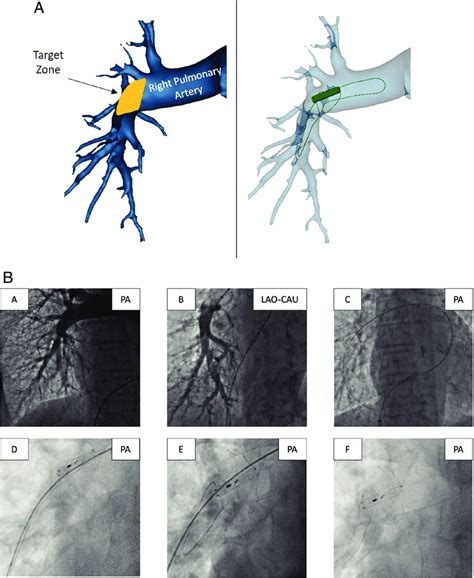 The Cordella Tm Pulmonary Artery Pressure Sensor A Schematic Of The