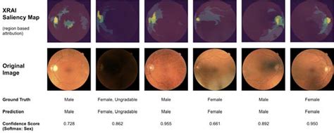 Predicting Sex From Retinal Fundus Photographs Using Automated Deep