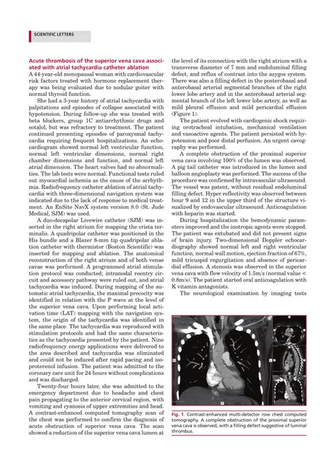 Pdf Efficacy Of Multielectrode Array Catheter For Ventricular Tachycardia Ablation In A