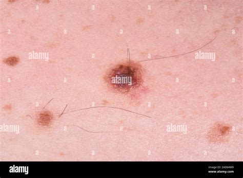 Compound Naevus Close Up Of A Benign Non Cancerous Compound Naevus Mole Centre On The Skin
