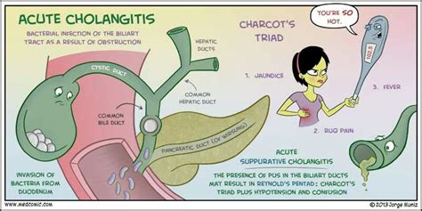 Acute Cholangitis And Acute Suppurative Cholangitis Triad Nursing