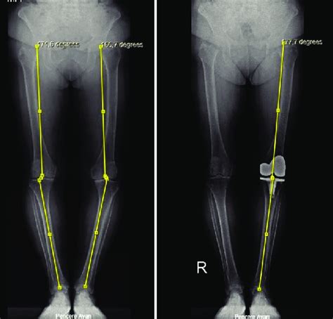 Picture Showing Improvement In Lower Extremity Alignment Before And